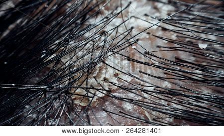 Hair Scalp Dandruff Image & Photo (Free Trial) | Bigstock