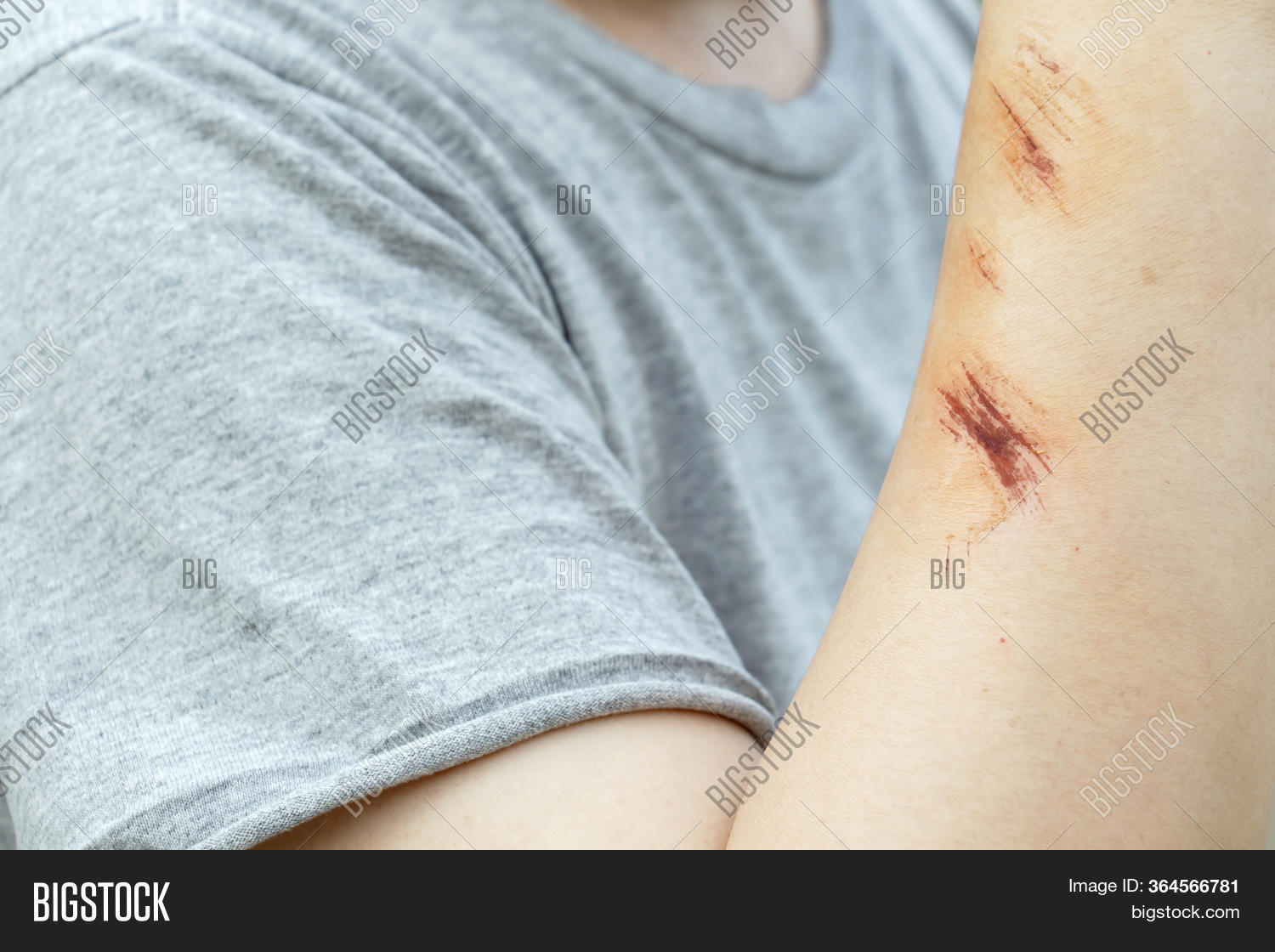 Wound Form Scabs On Image & Photo (Free Trial) | Bigstock
