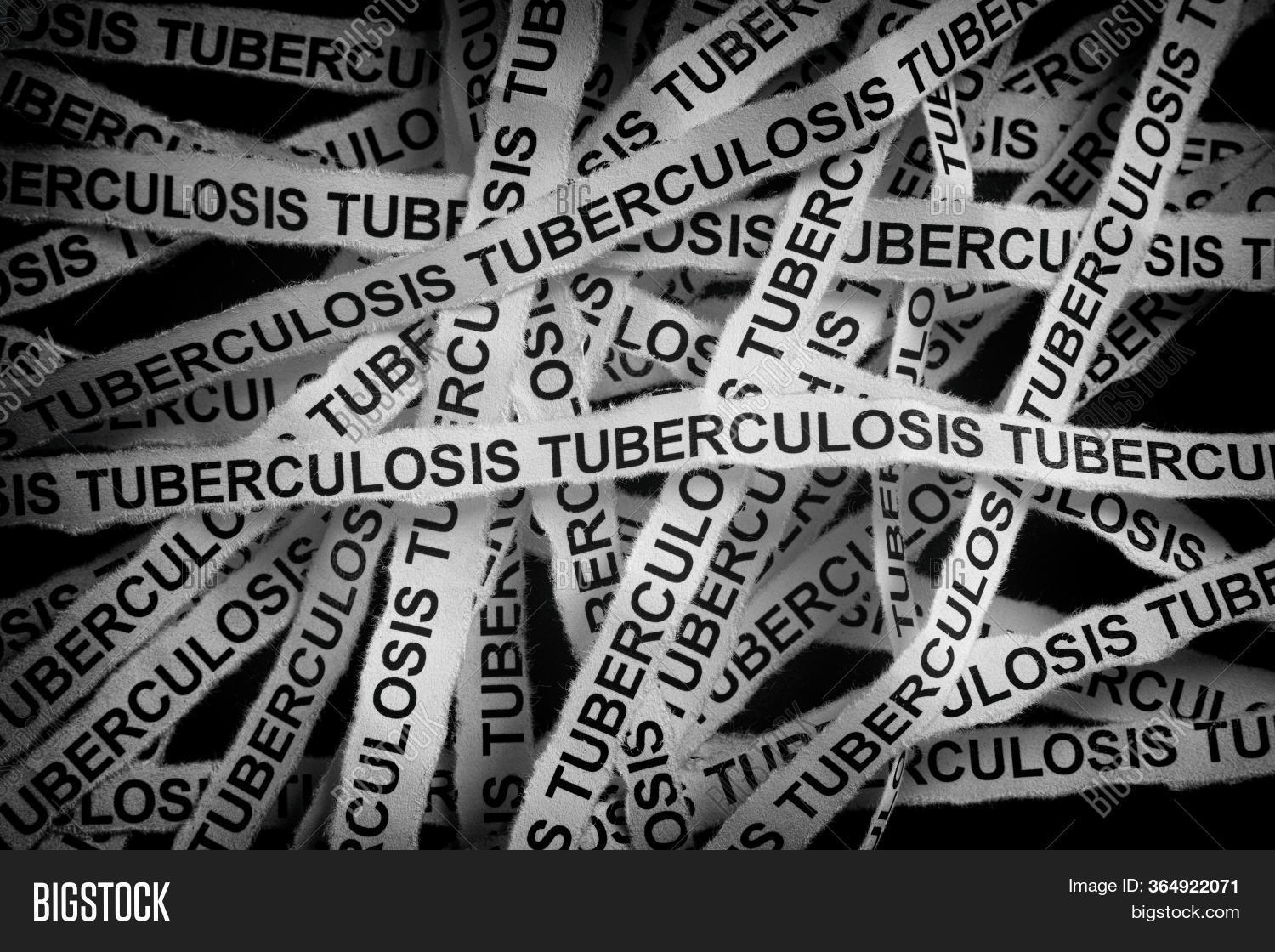 Tuberculosis. Strips Image & Photo (Free Trial) | Bigstock
