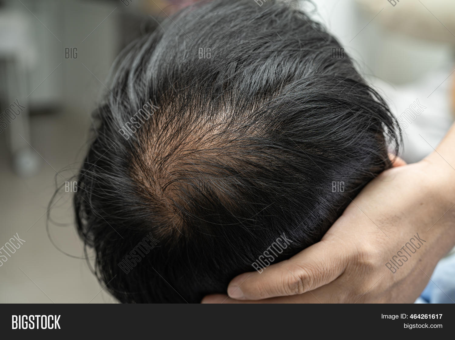 Bald Middle Head Begin Image & Photo (Free Trial) | Bigstock