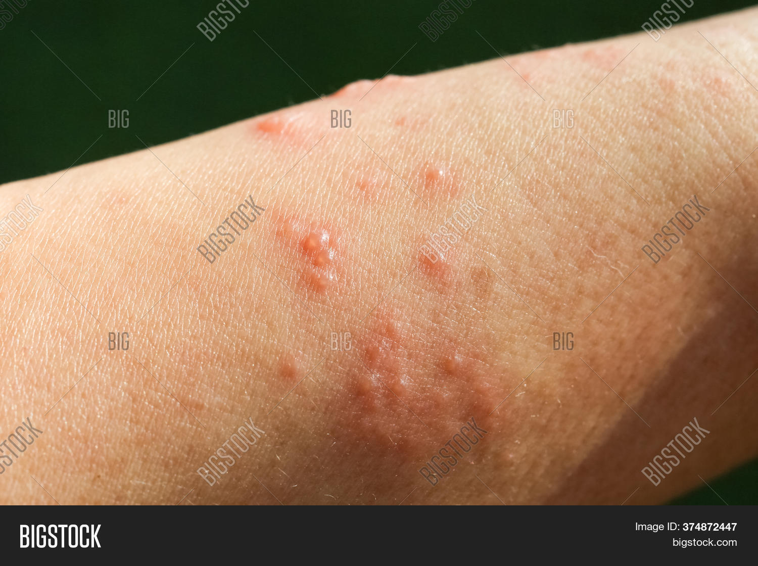 Skin Rash Allergic Image & Photo (Free Trial) | Bigstock