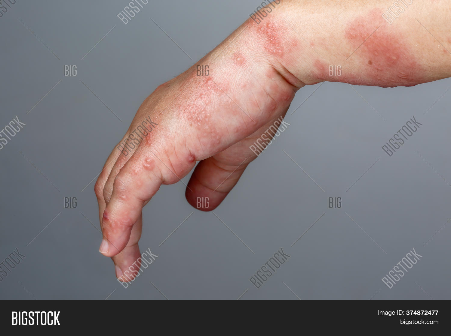 Shingles, Zoster Image & Photo (Free Trial) | Bigstock