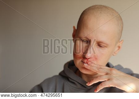 Hairless Cancer Sick Image & Photo (Free Trial) | Bigstock