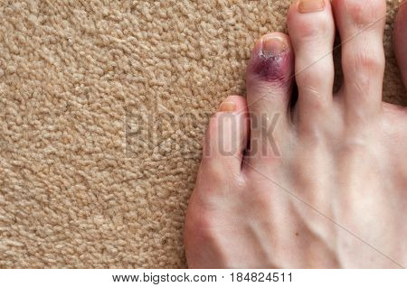 Broken Toe Showing Image & Photo (Free Trial) | Bigstock