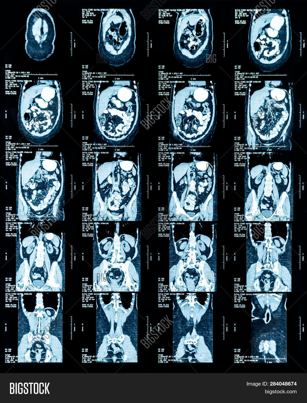 Mri Scan Image Chest Image & Photo (Free Trial) | Bigstock
