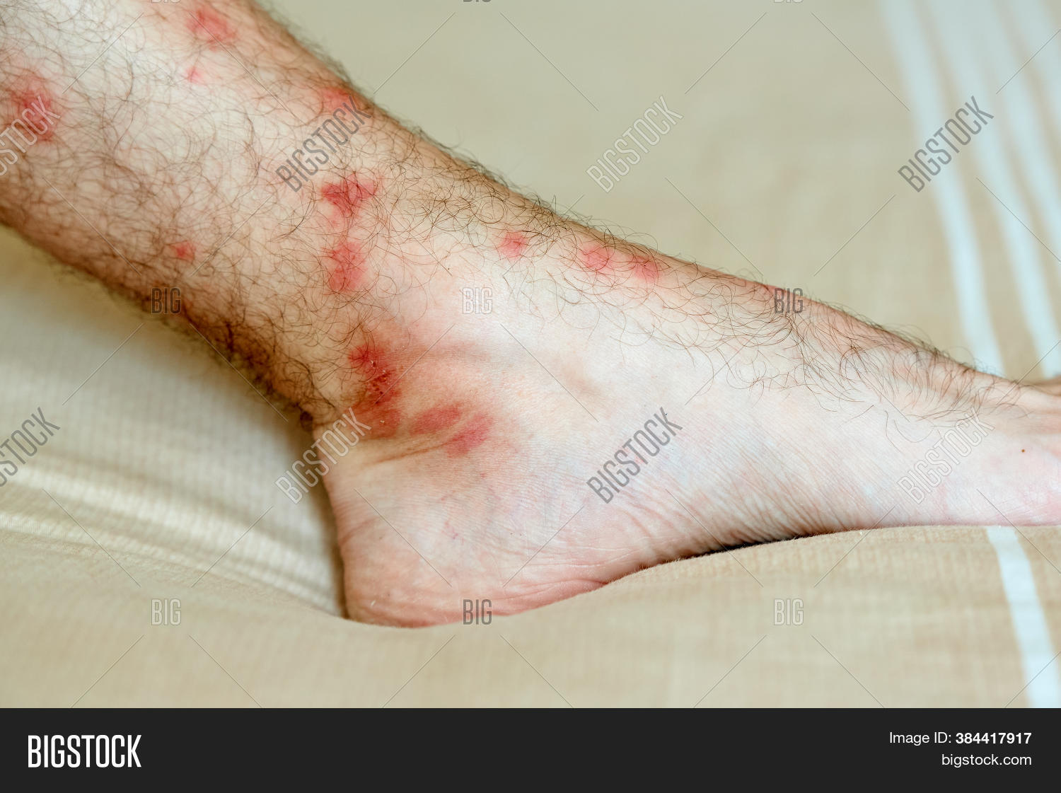 Male Leg Many Red Spot Image & Photo (Free Trial) | Bigstock