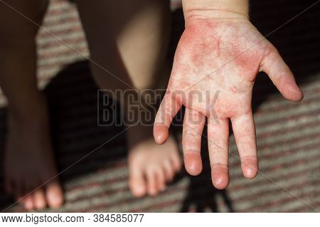 Red Rash On Hands Image & Photo (Free Trial) | Bigstock