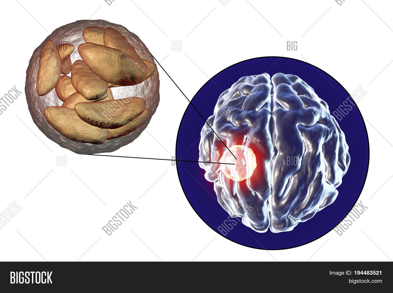 Brain Abscess Caused Image & Photo (Free Trial) | Bigstock