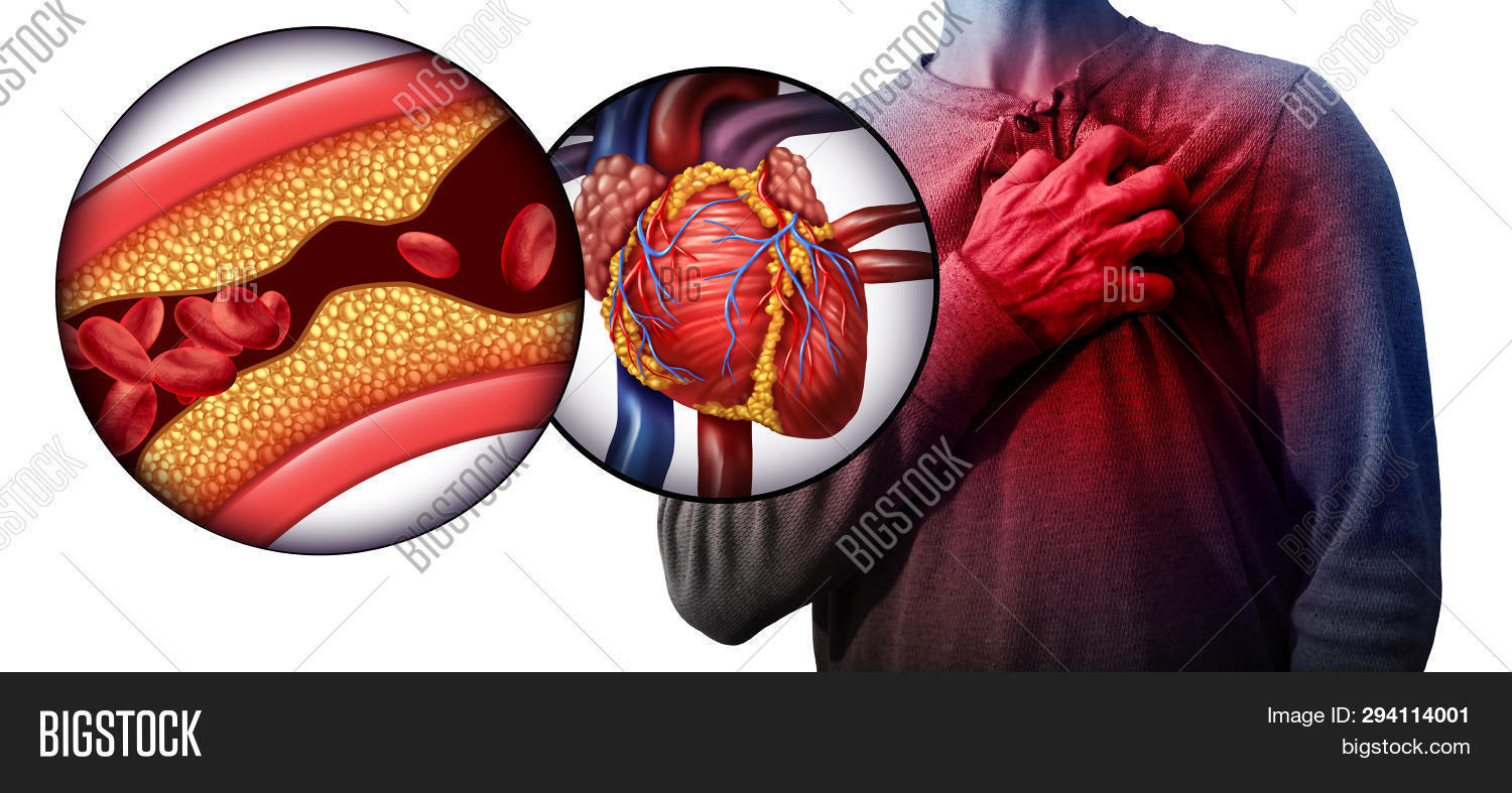 Myocardial Infarction Image & Photo (Free Trial) | Bigstock