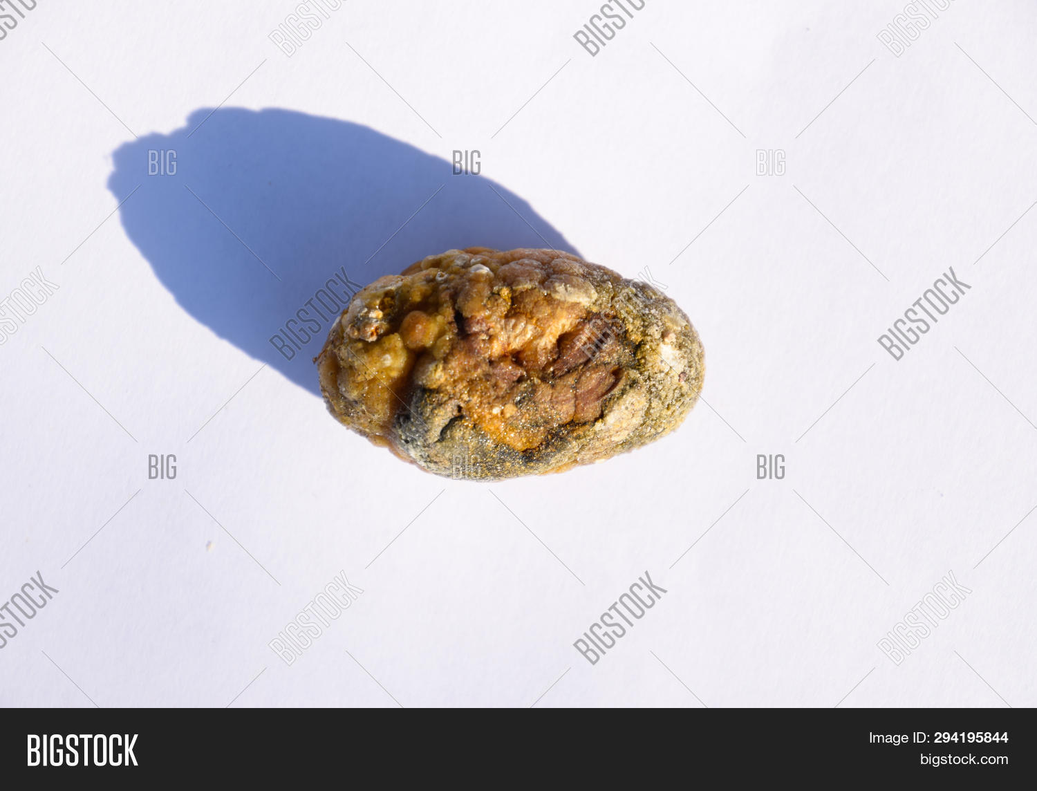 Stone Gallbladder. Image & Photo (Free Trial) | Bigstock