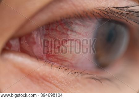 Closeup Irritated Image & Photo (Free Trial) | Bigstock