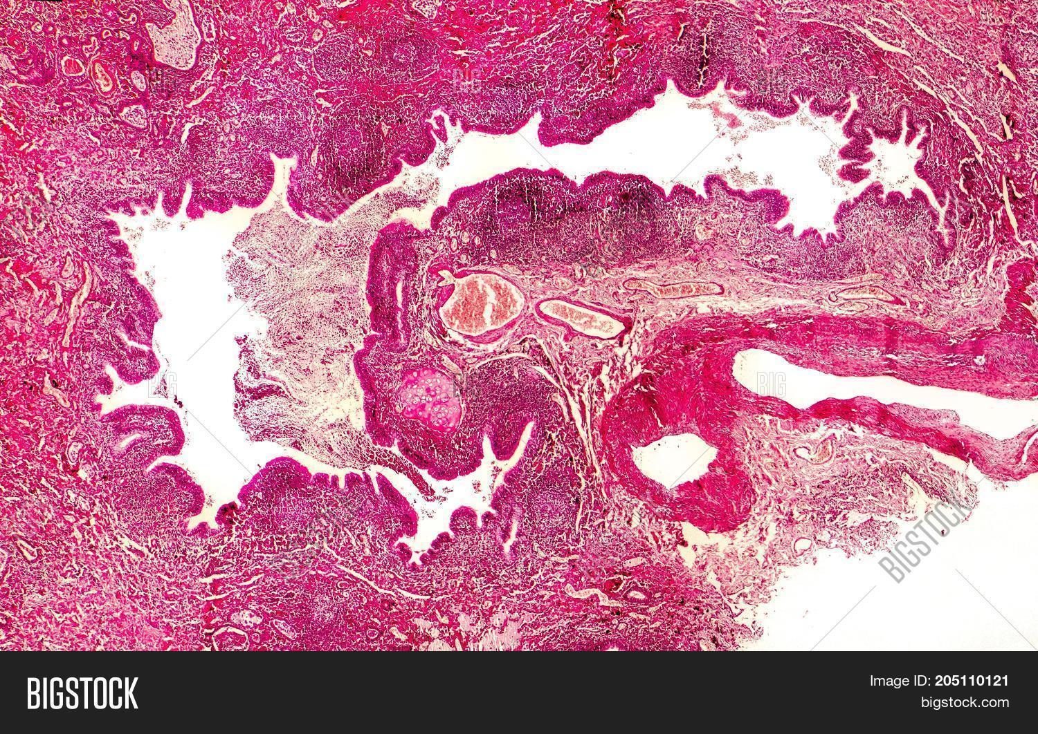 Bronchiectasis, Cross- Image & Photo (Free Trial) | Bigstock