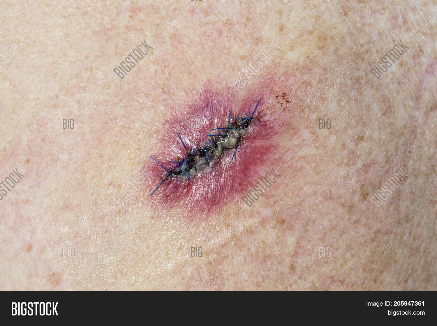 Stitched Incision Image & Photo (Free Trial) | Bigstock