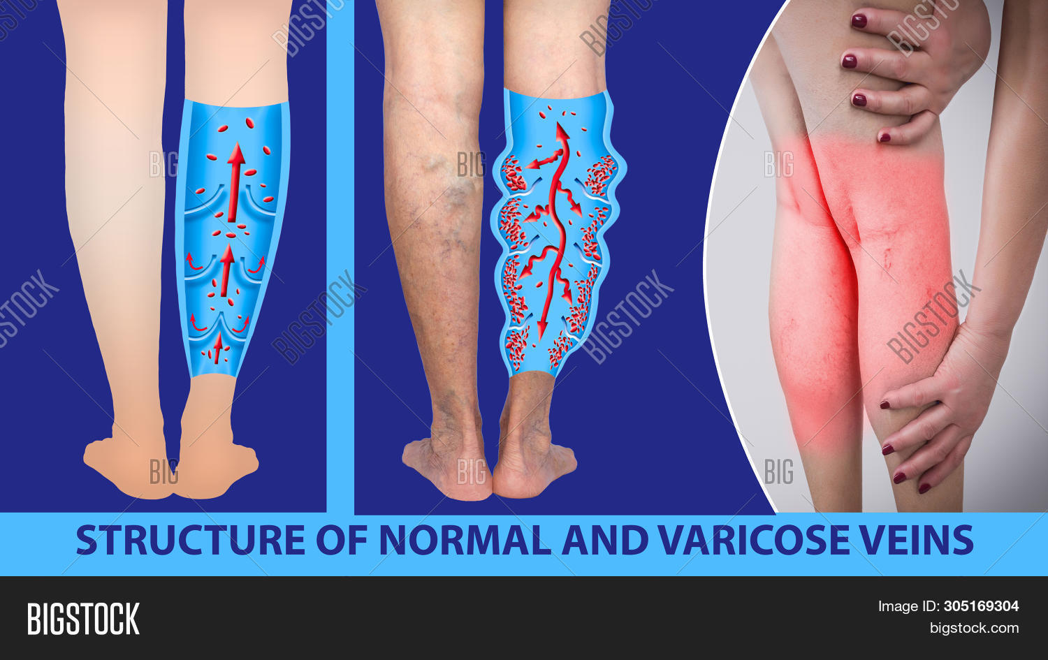 Varicose Veins On Image & Photo (Free Trial) | Bigstock