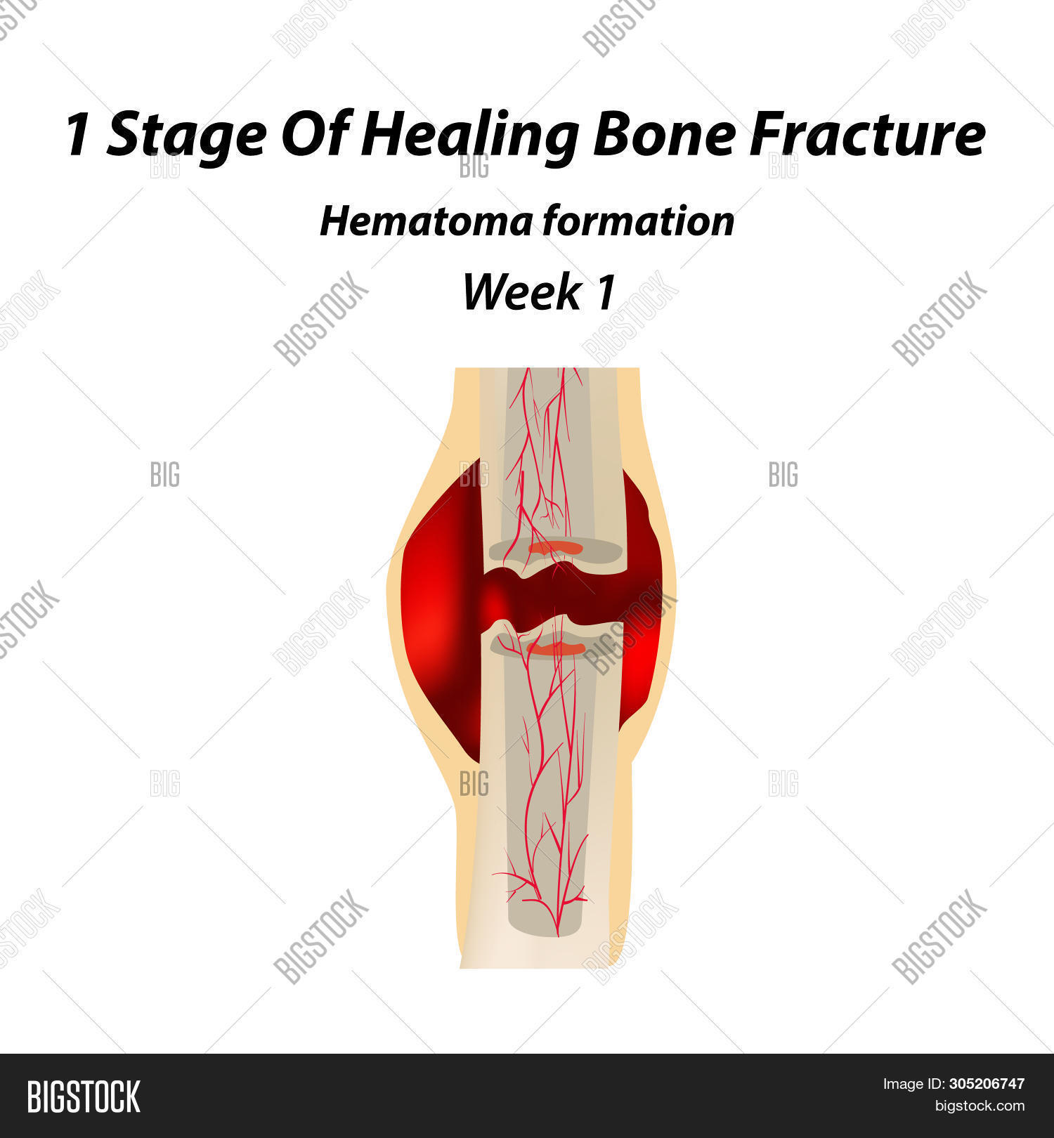 1 Stage Healing Bone Image & Photo (Free Trial) | Bigstock