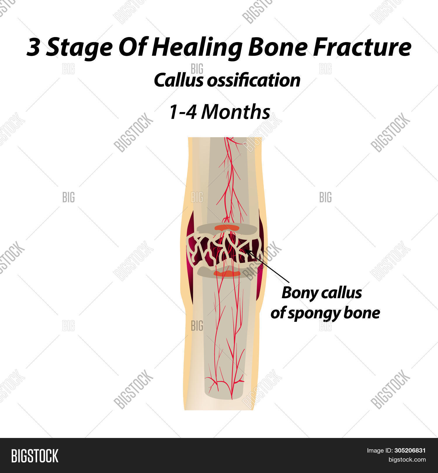 3 Stage Healing Bone Image & Photo (Free Trial) | Bigstock
