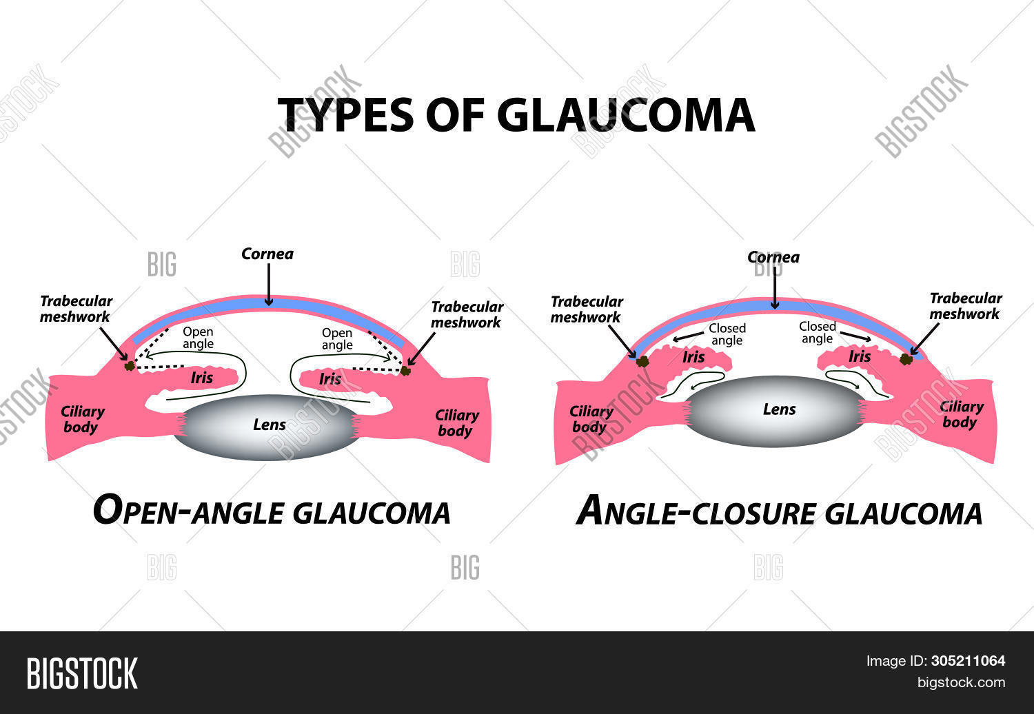 Types Glaucoma. Open- Image & Photo (Free Trial) | Bigstock