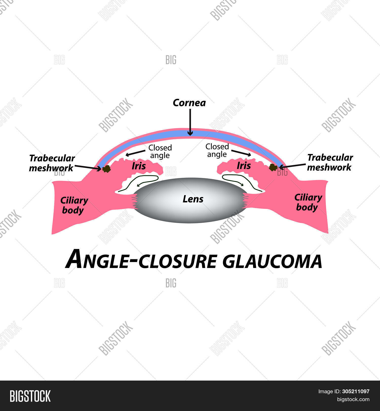 Closed Angle Glaucoma Image & Photo (Free Trial) | Bigstock