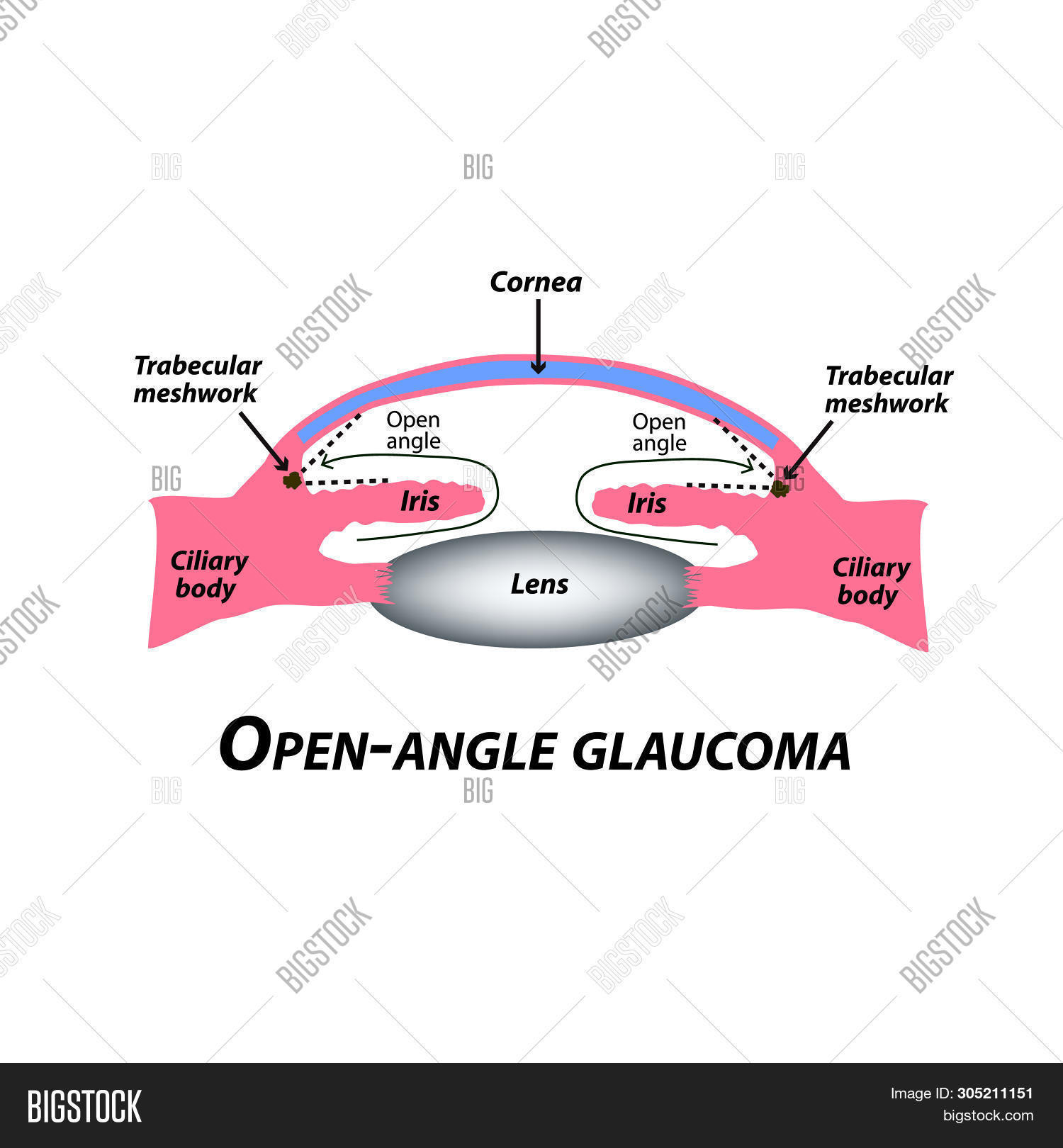 Open-angle Glaucoma. Image & Photo (Free Trial) | Bigstock