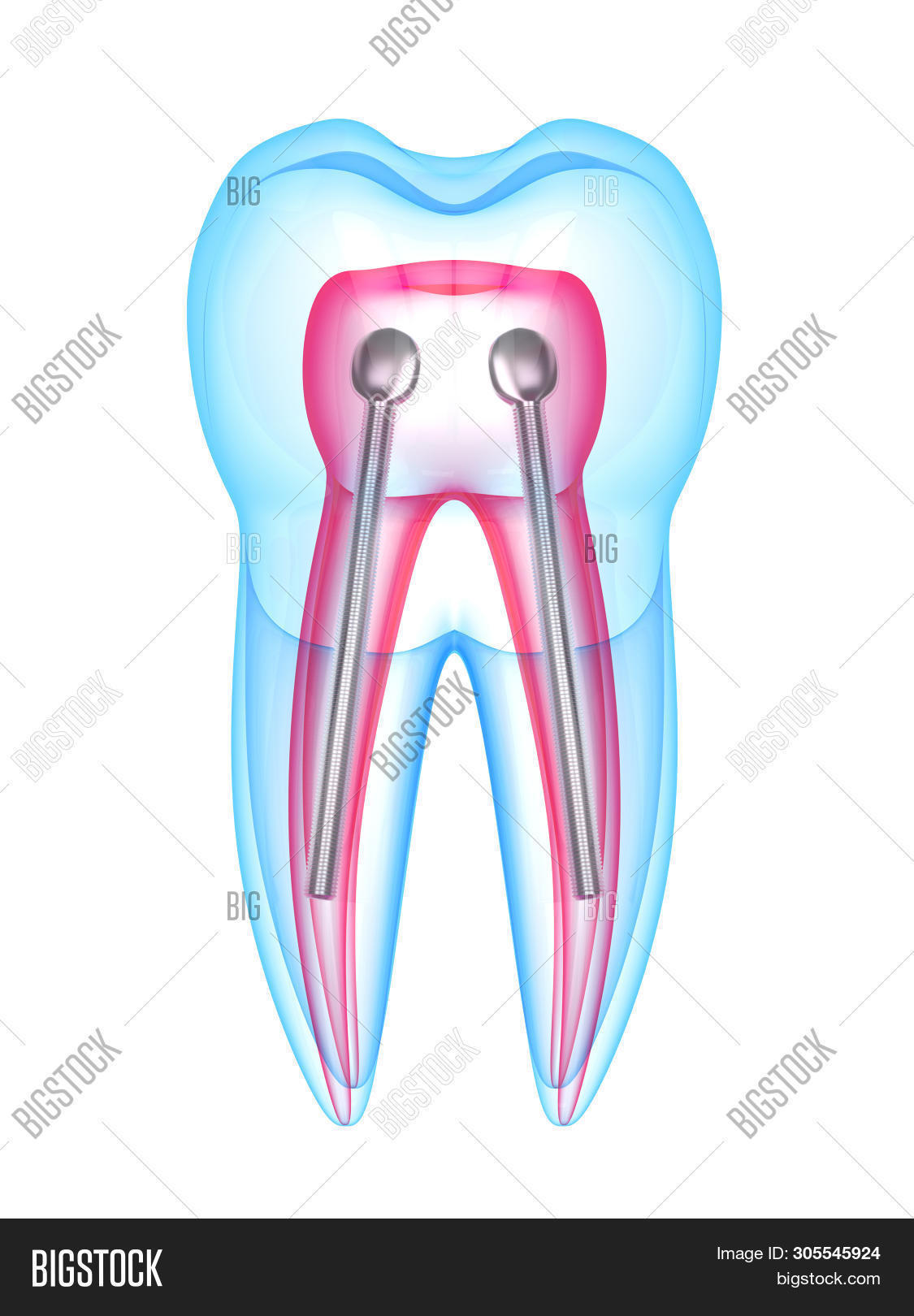 3d Render X-ray Tooth Image & Photo (Free Trial) | Bigstock