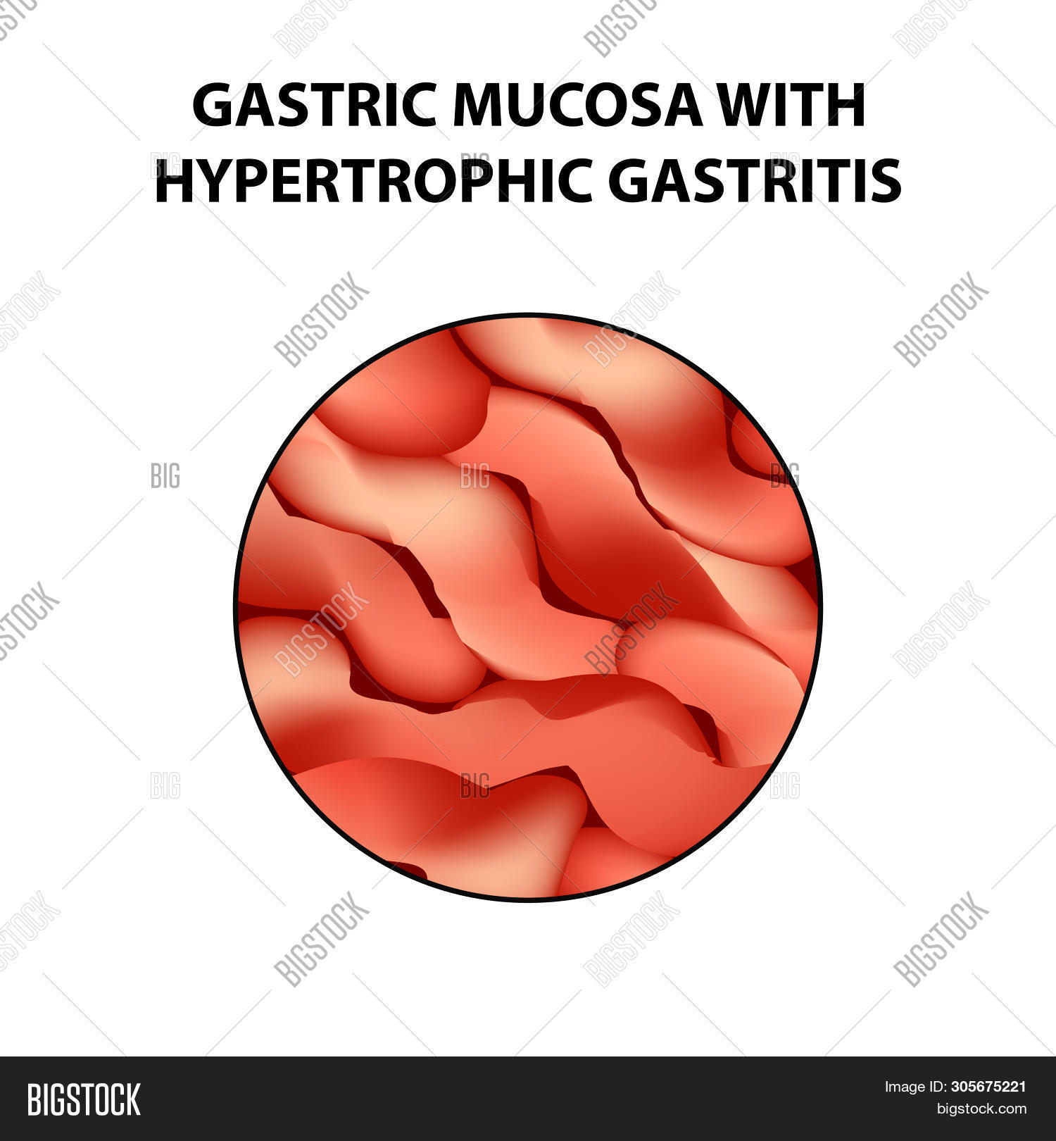 Gastric Mucosa Image & Photo (Free Trial) | Bigstock