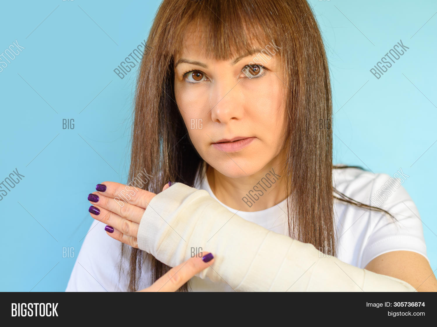 Imagen y foto Woman Broken Arm (prueba gratis) | Bigstock