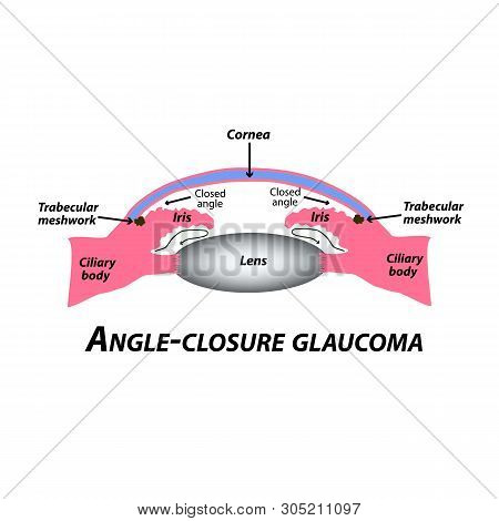 Closed Angle Glaucoma Image & Photo (Free Trial) | Bigstock