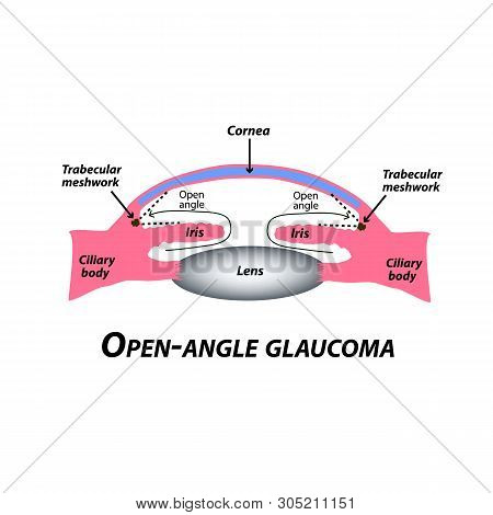 Open-angle Glaucoma. Image & Photo (Free Trial) | Bigstock