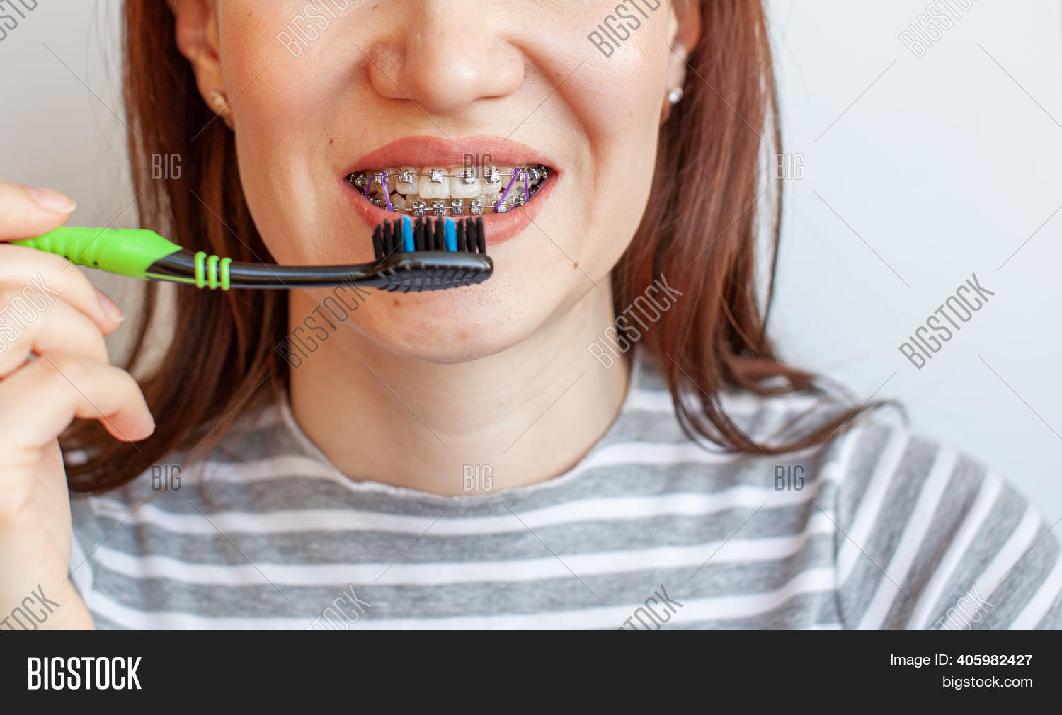 Braces Smiling Mouth Image & Photo (Free Trial) | Bigstock