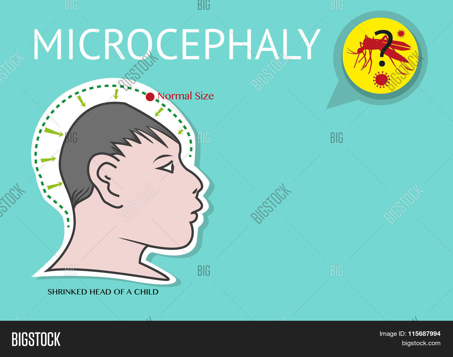 Microcephaly Abnormal Vector & Photo (Free Trial) | Bigstock