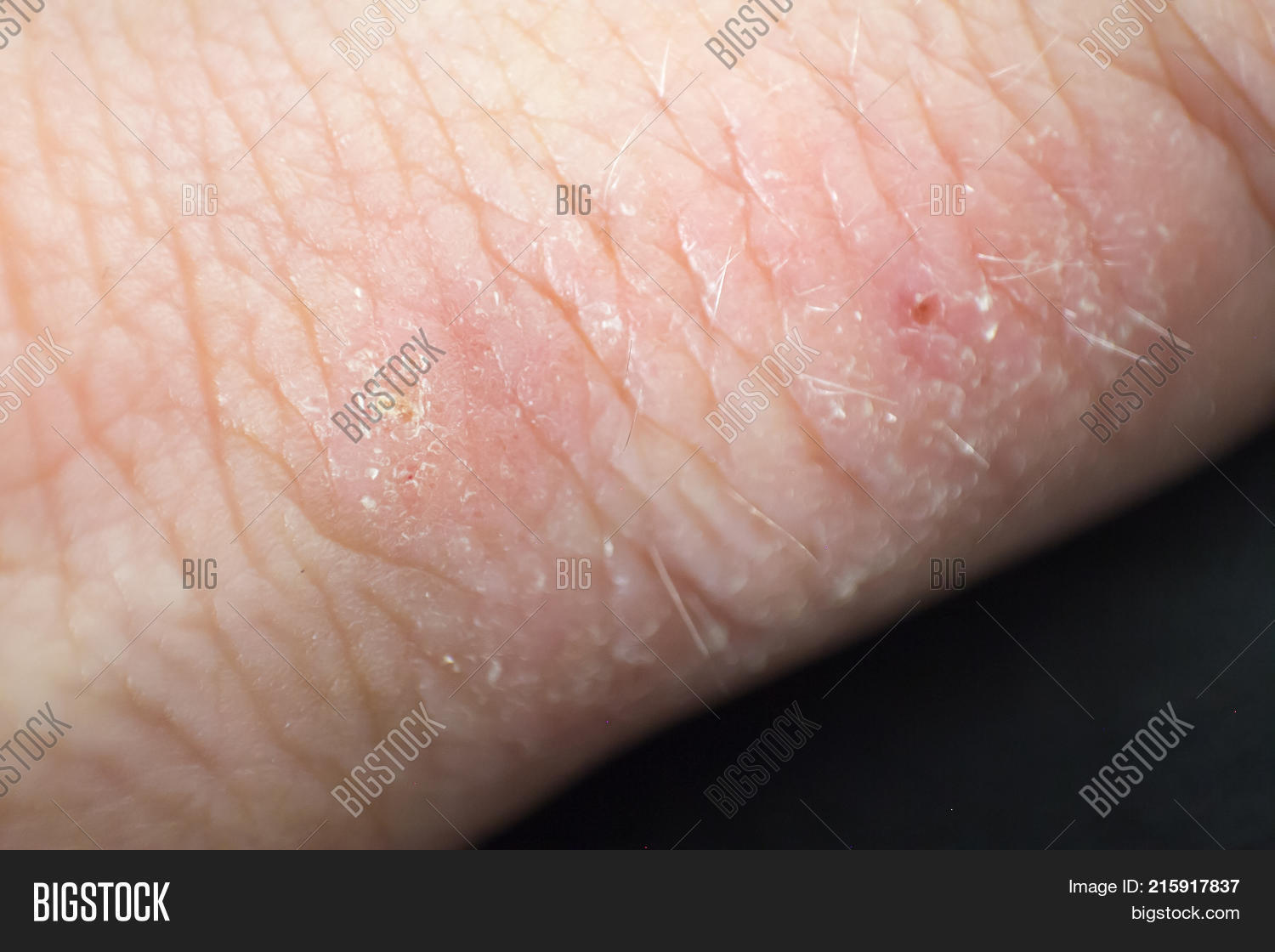 Hand Dermatitis. Hand Image & Photo (Free Trial) | Bigstock