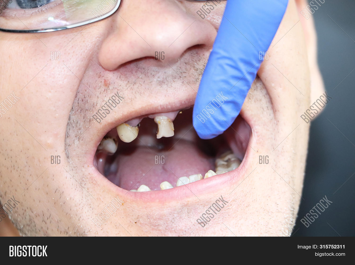 Man Has Rotten Teeth, Image & Photo (Free Trial) | Bigstock