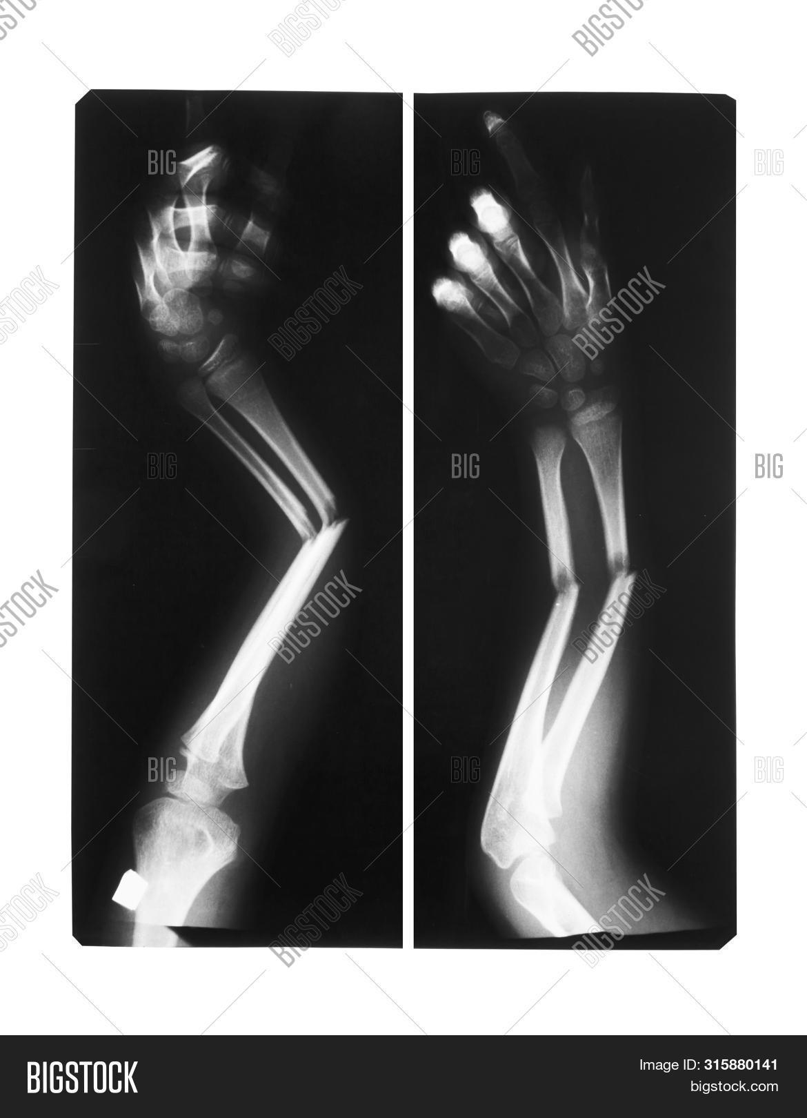 Show Double Fracture Image & Photo (Free Trial) | Bigstock