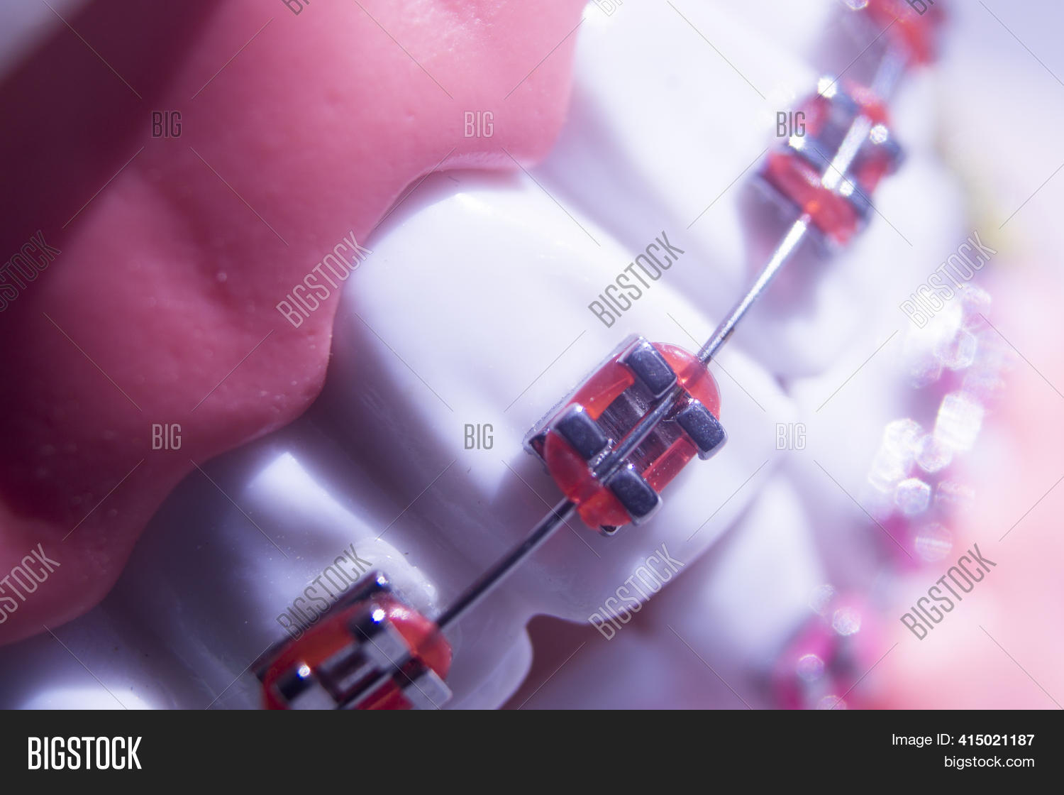 Metal Teeth Brackets Image & Photo (Free Trial) | Bigstock