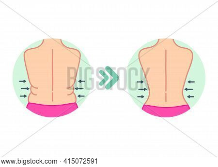 Fat On Back. Fat Vector & Photo (Free Trial) | Bigstock