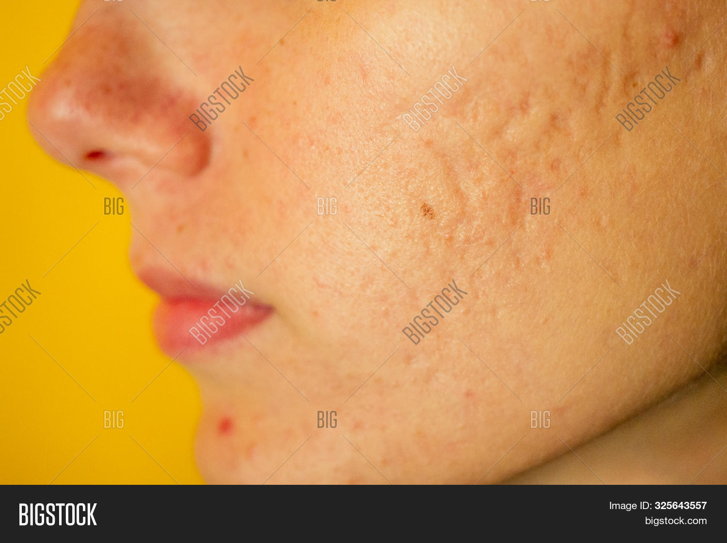 Post-acne, Scars Red Image & Photo (Free Trial) | Bigstock