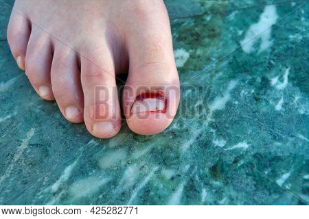 Big Toe Damaged Image & Photo (Free Trial) | Bigstock