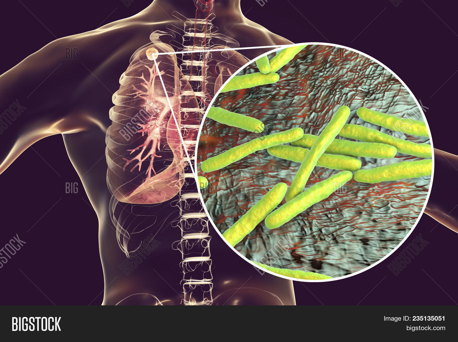 Secondary Tuberculosis Image & Photo (Free Trial) | Bigstock