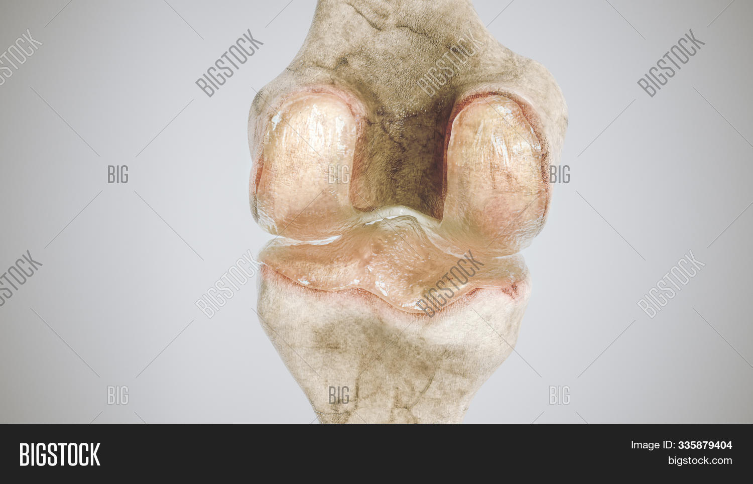 Mild Osteoarthritis - Image & Photo (Free Trial) | Bigstock