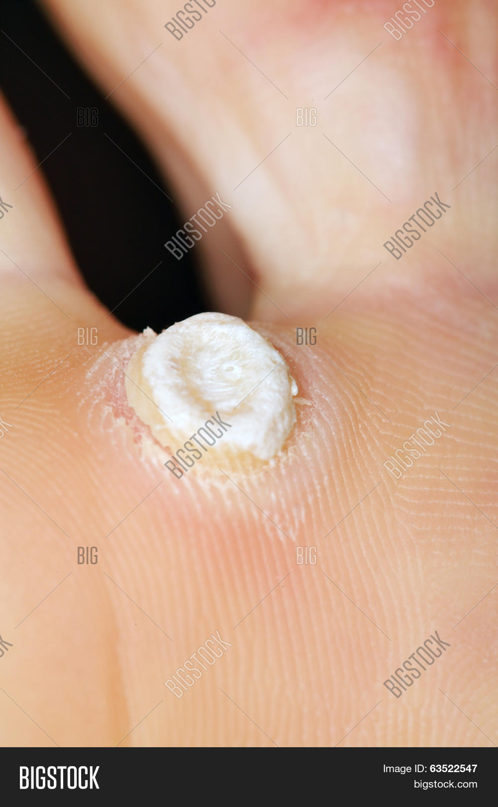 Falling Off Wart On Image & Photo (Free Trial) | Bigstock