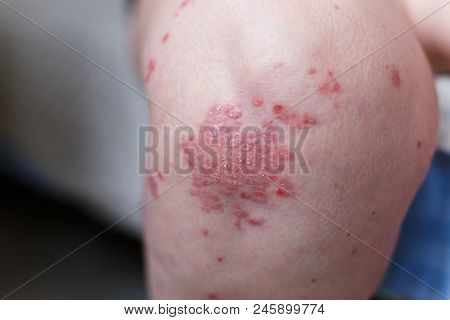 Allergic Rash Image & Photo (Free Trial) | Bigstock