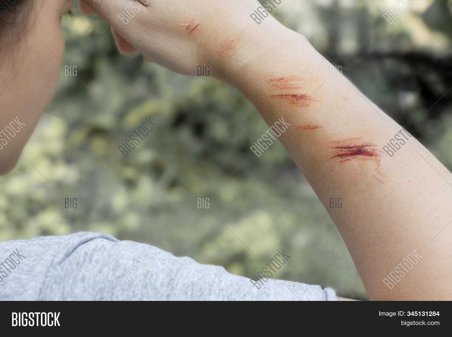 Wound Form Scabs On Image & Photo (Free Trial) | Bigstock