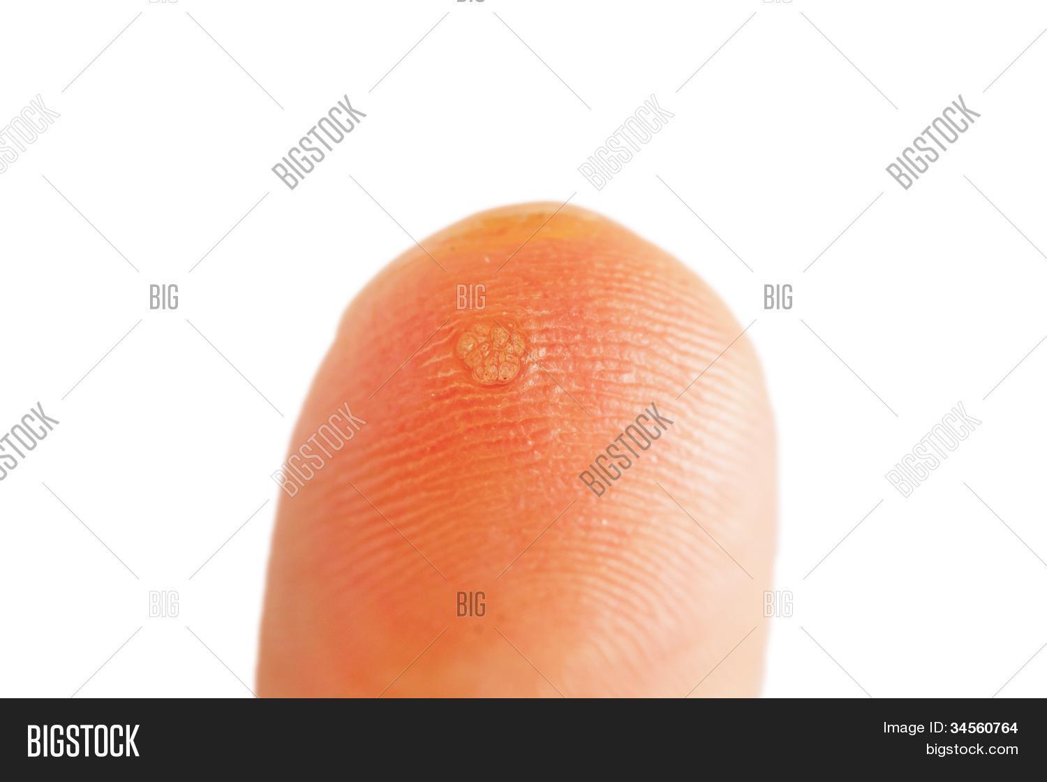 Verruca Formation Image & Photo (Free Trial) | Bigstock
