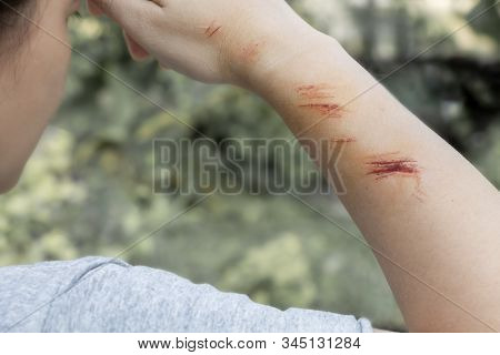 Wound Form Scabs On Image & Photo (Free Trial) | Bigstock