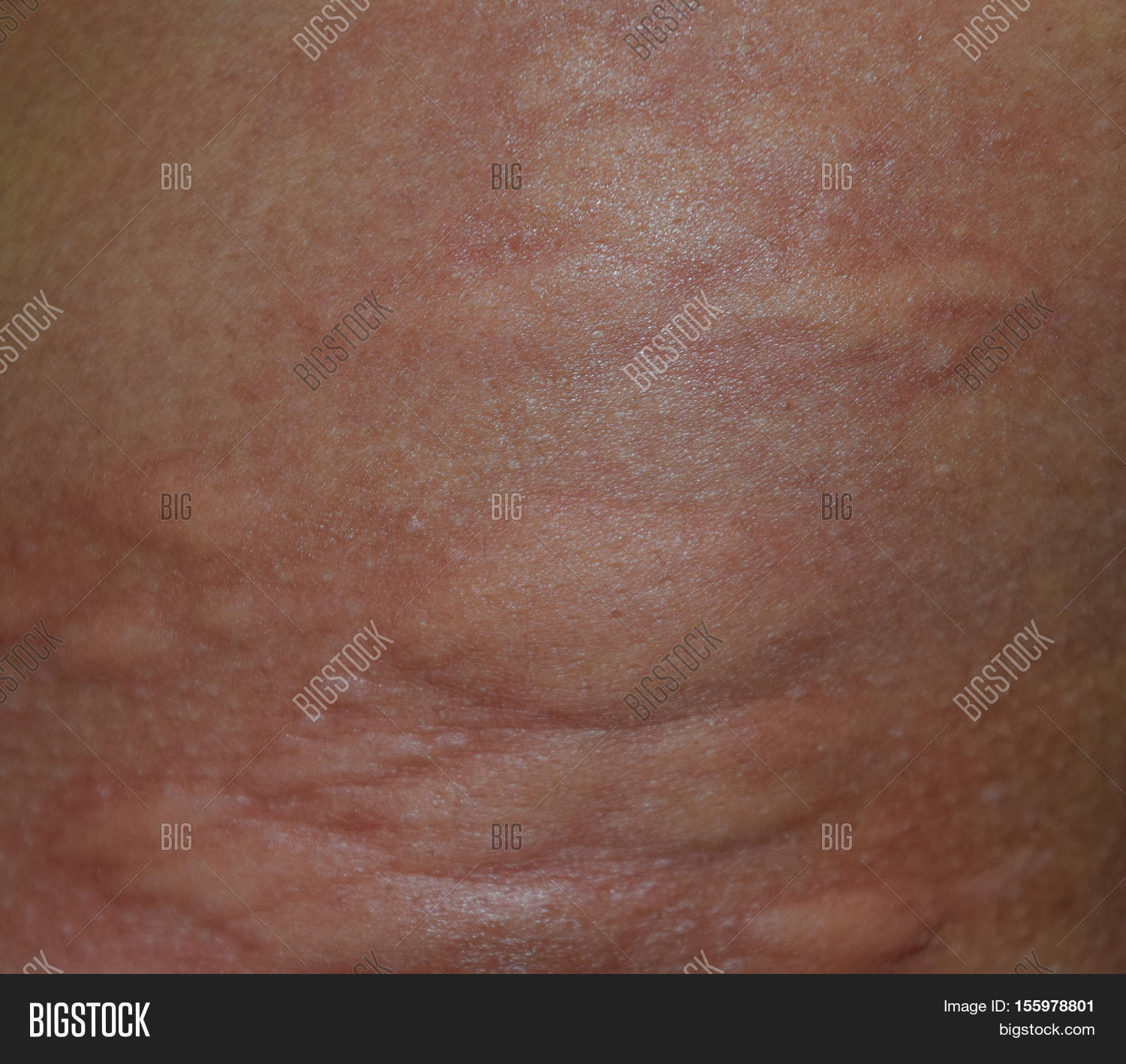 Allergy Skin Back Image & Photo (Free Trial) | Bigstock