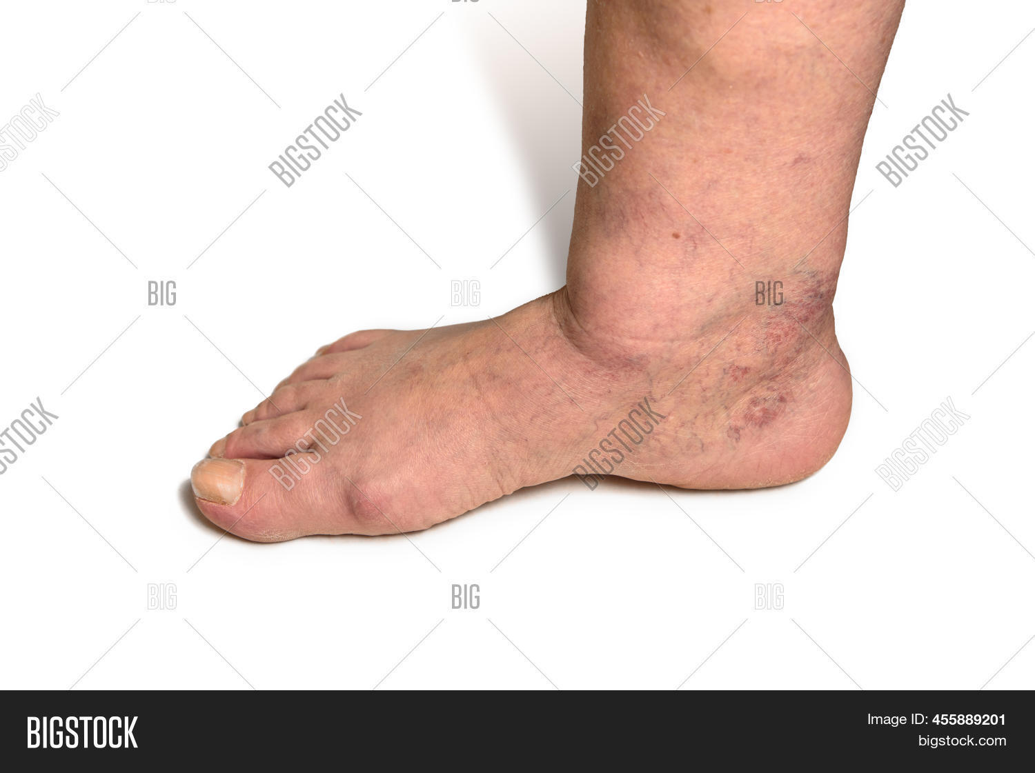 Swelling Female Leg Image & Photo (Free Trial) | Bigstock