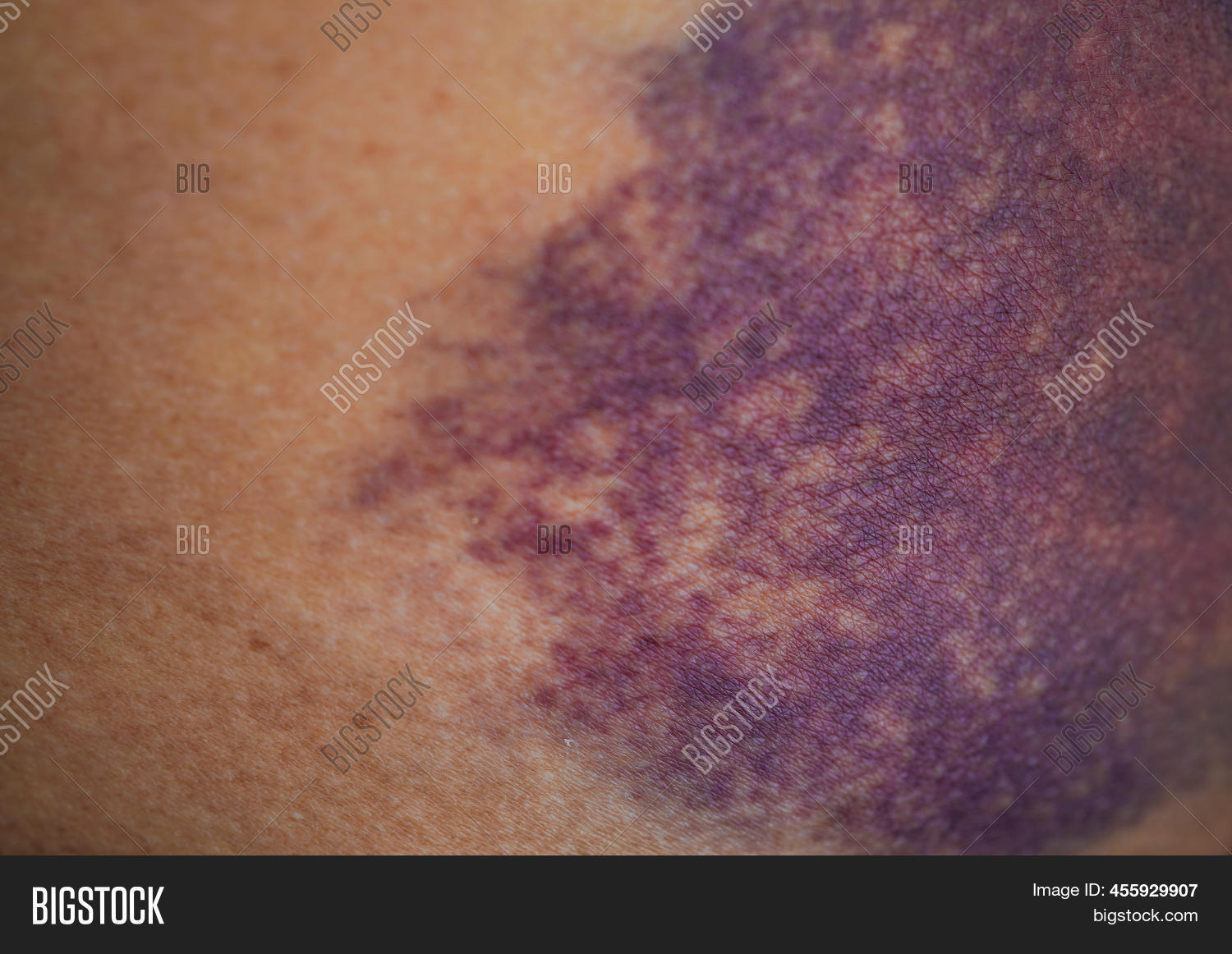Bruise On Buttock Skin Image & Photo (Free Trial) | Bigstock