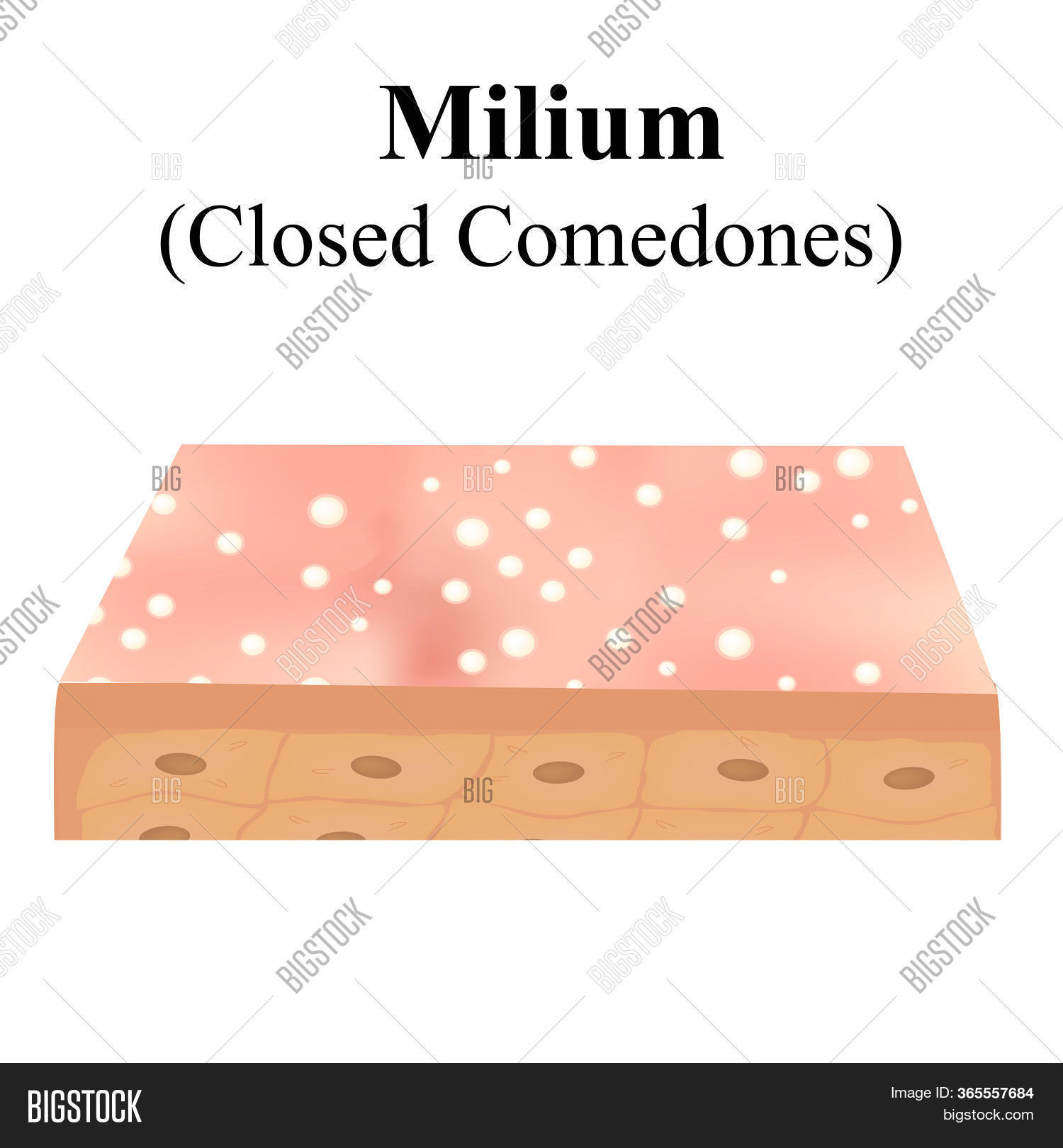 Closed Comedones. Acne Image & Photo (Free Trial) | Bigstock