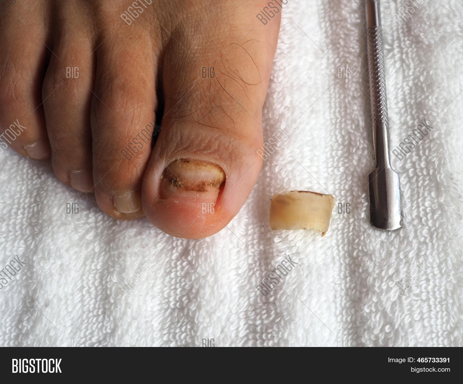 Nail Injury When To See A Doctor at Mae Kimbrell blog