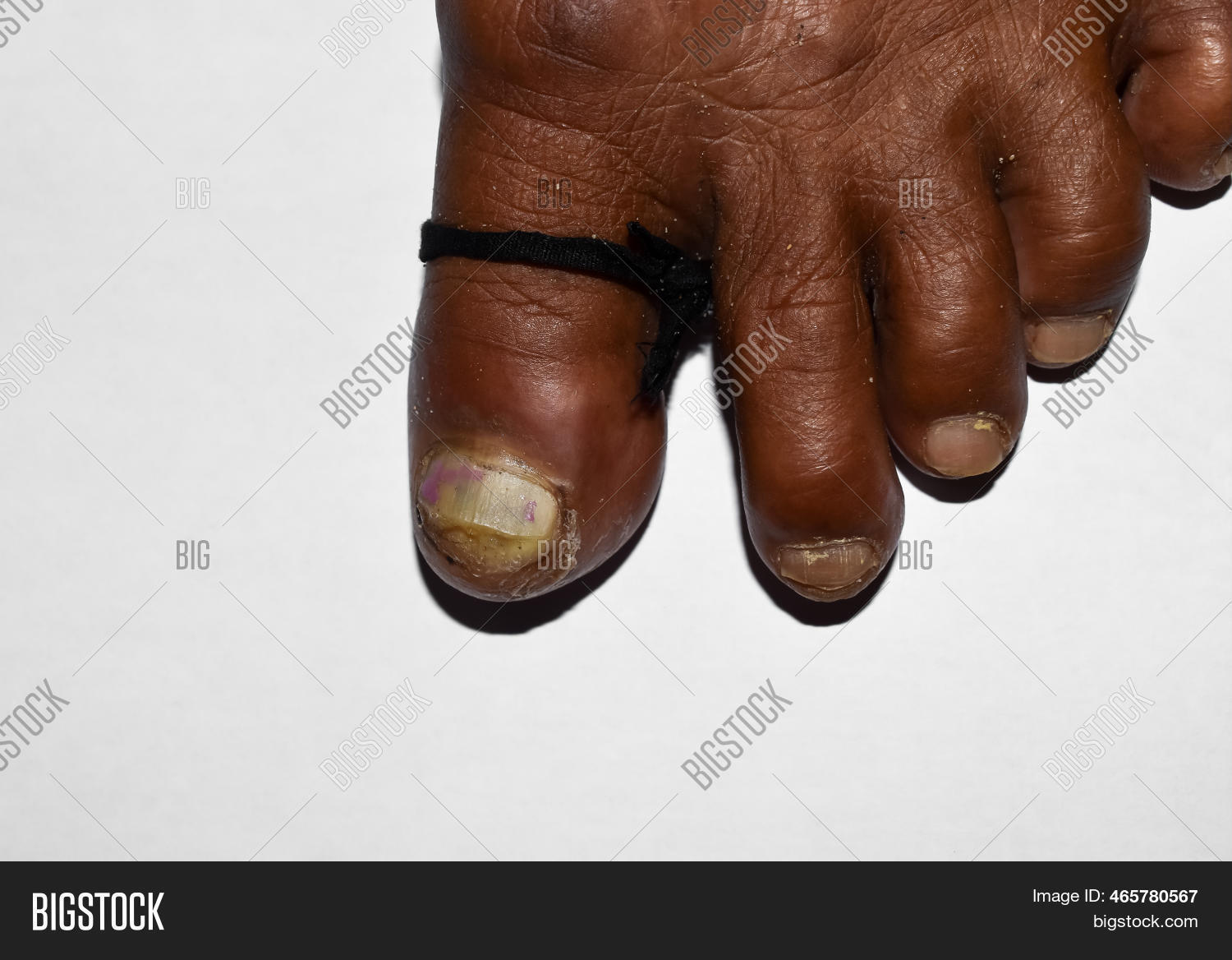 Acute Paronychia Image & Photo (Free Trial) | Bigstock